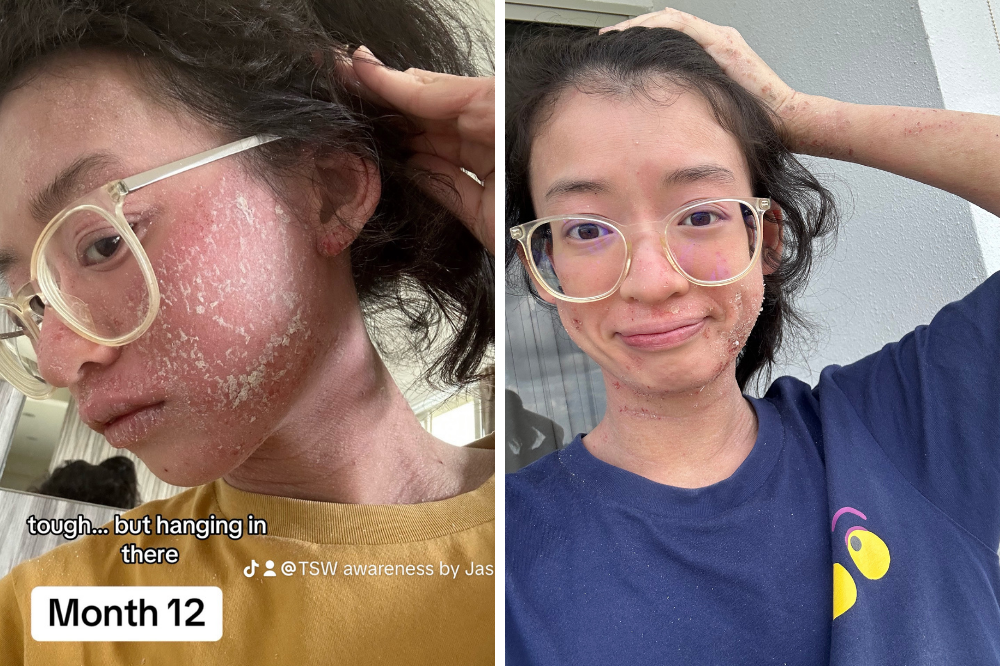 I Suffer From Topical Steroid Withdrawal With Itchy & Flared Skin