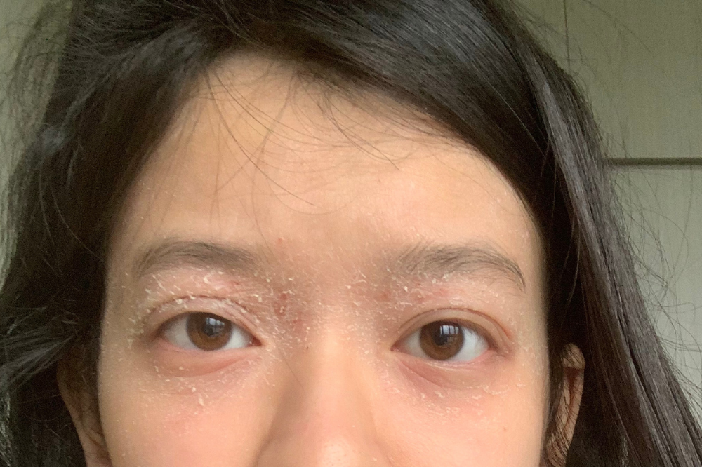 I Suffer From Topical Steroid Withdrawal With Itchy & Flared Skin