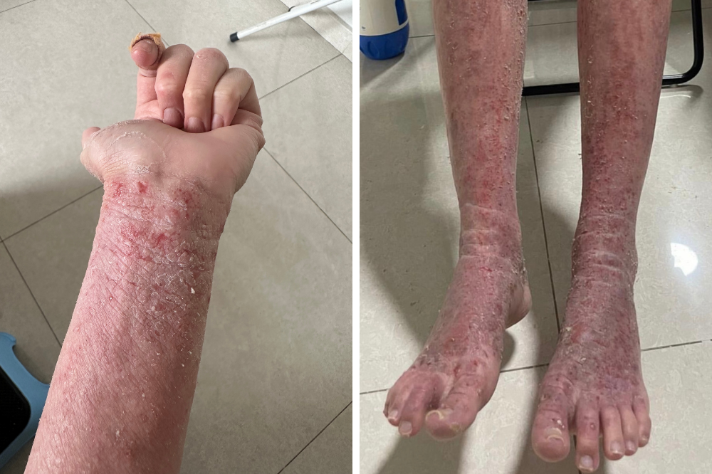 I Suffer From Topical Steroid Withdrawal With Itchy & Flared Skin