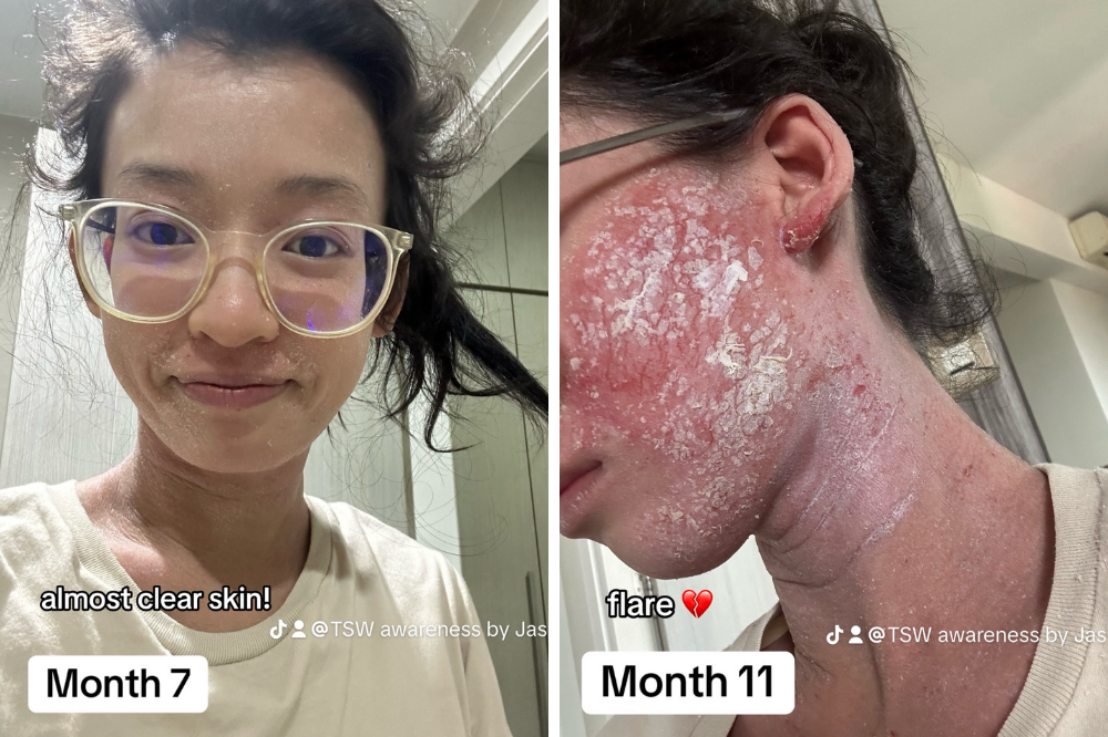 I Suffer From Topical Steroid Withdrawal With Itchy & Flared Skin