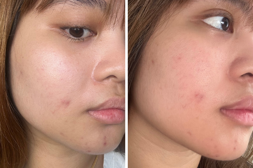 4 Girls Try The Viral Kiehl’s Invisible Liquid Patch