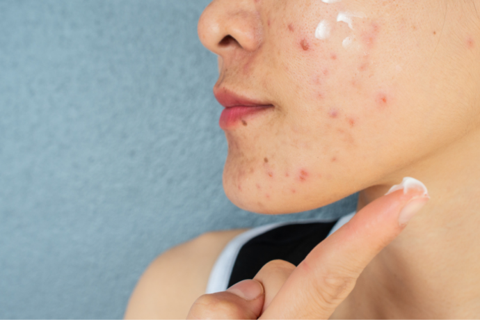 A Guide To Pimples & How To Get Rid Of Them
